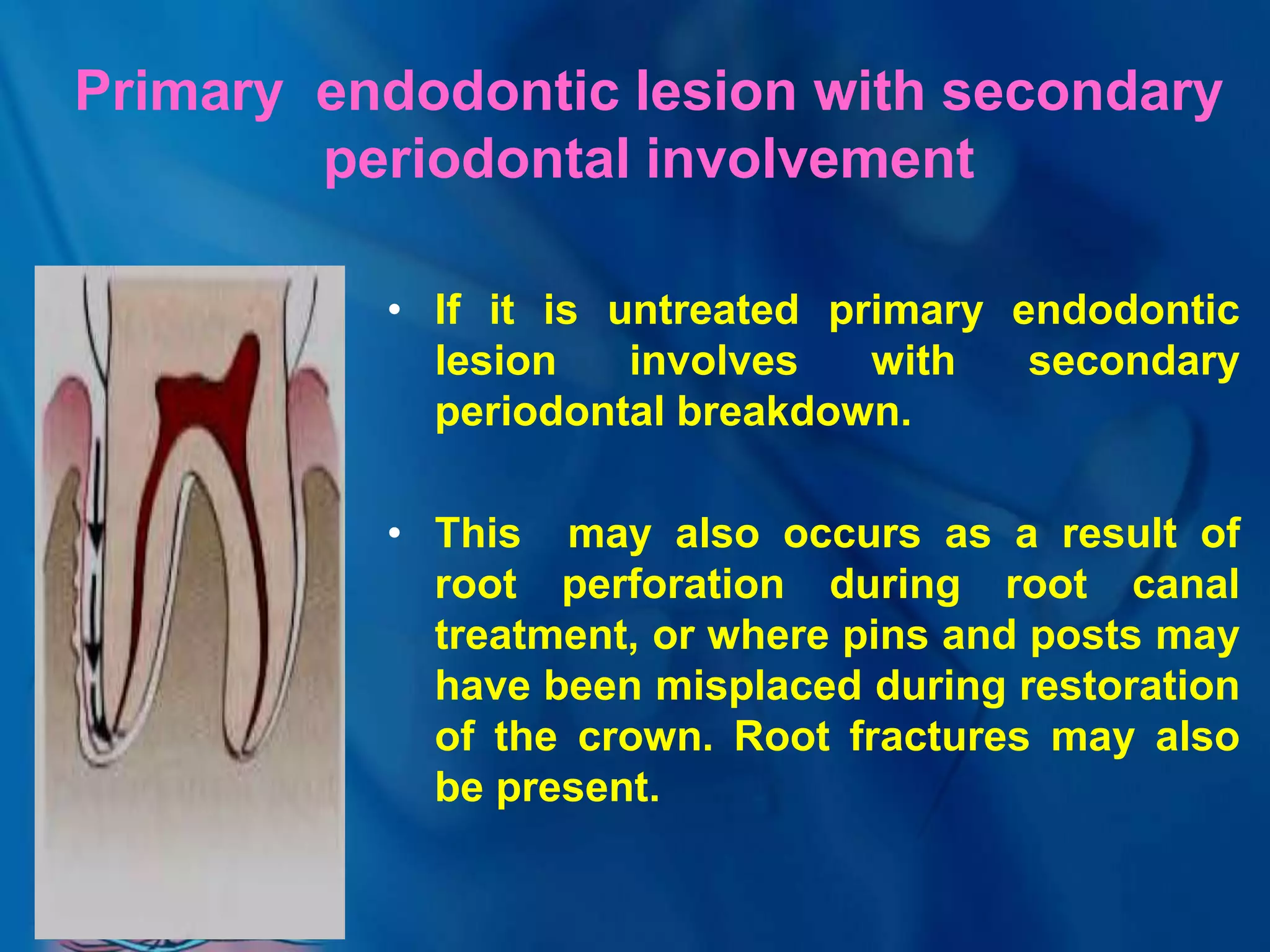 Endo – Perio lesions.ppt