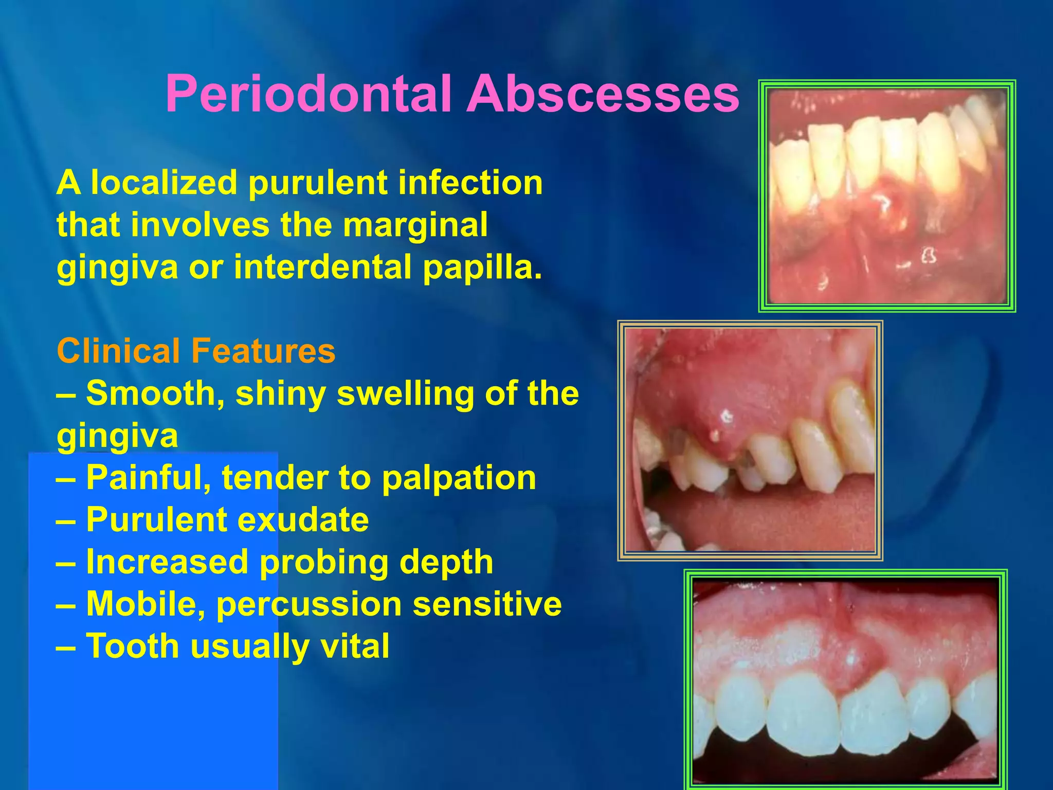 Endo – Perio lesions.ppt