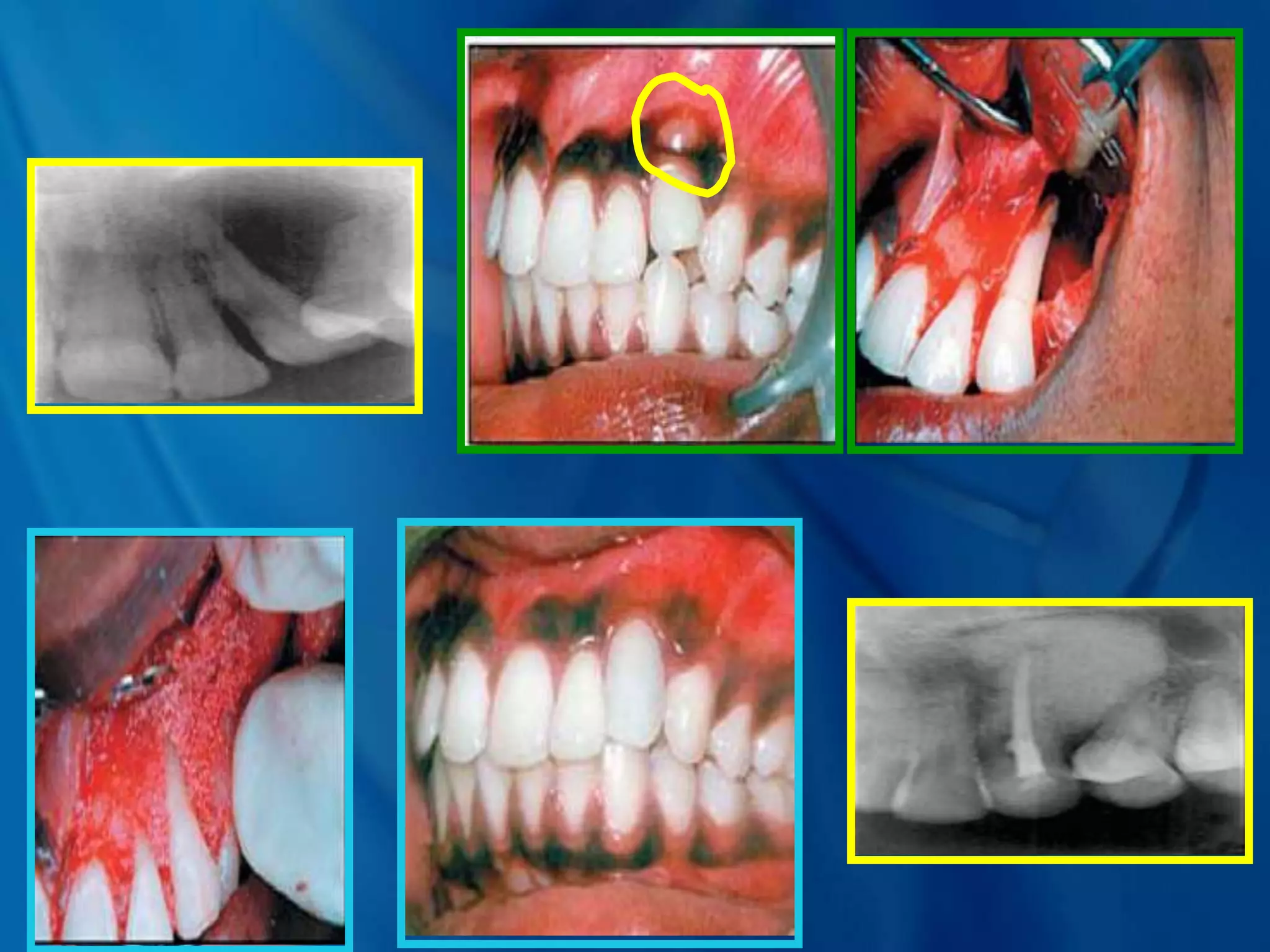 Endo – Perio lesions.ppt