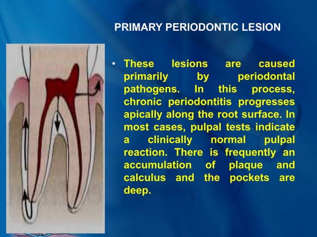 Endo – Perio lesions.ppt