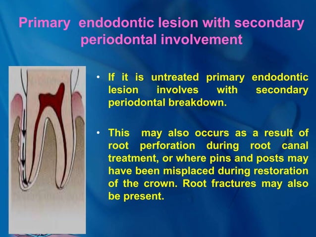 Endo – Perio lesions.ppt