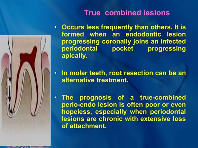 Endo – Perio lesions.ppt