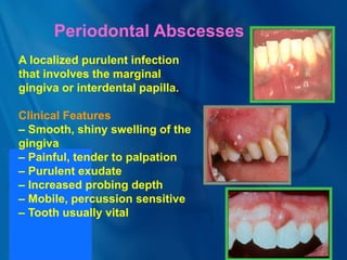 Endo – Perio lesions.ppt
