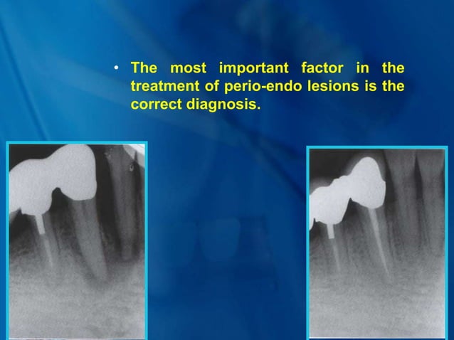 Endo – Perio lesions.ppt