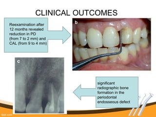 Use of Platelet-Rich Plasma Combined With Hydroxyapatite in the ...