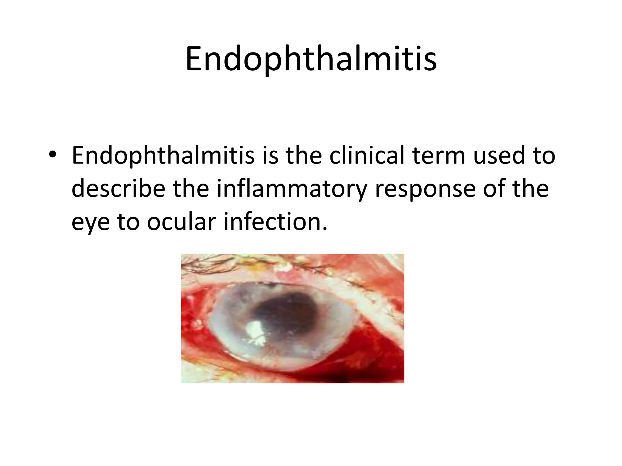 EndophTHALMITIS MANAGEMENT -AJAY DUDANI | PPTX