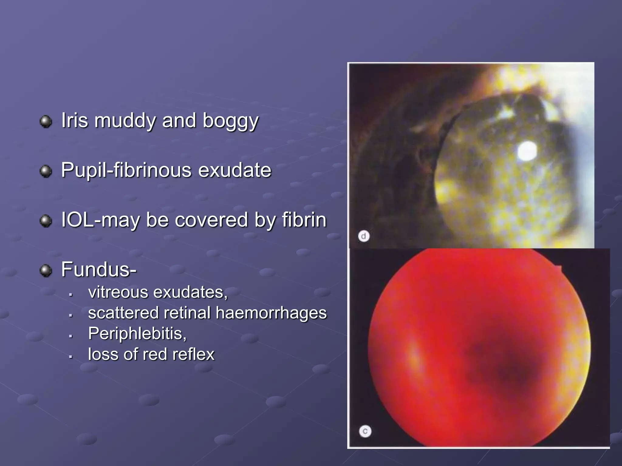 Endophthalmitis | PPTX