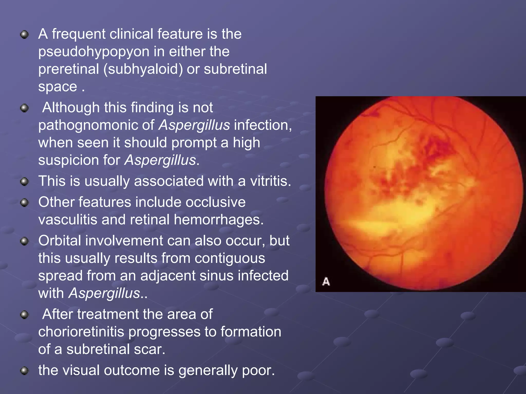 Endophthalmitis | PPTX