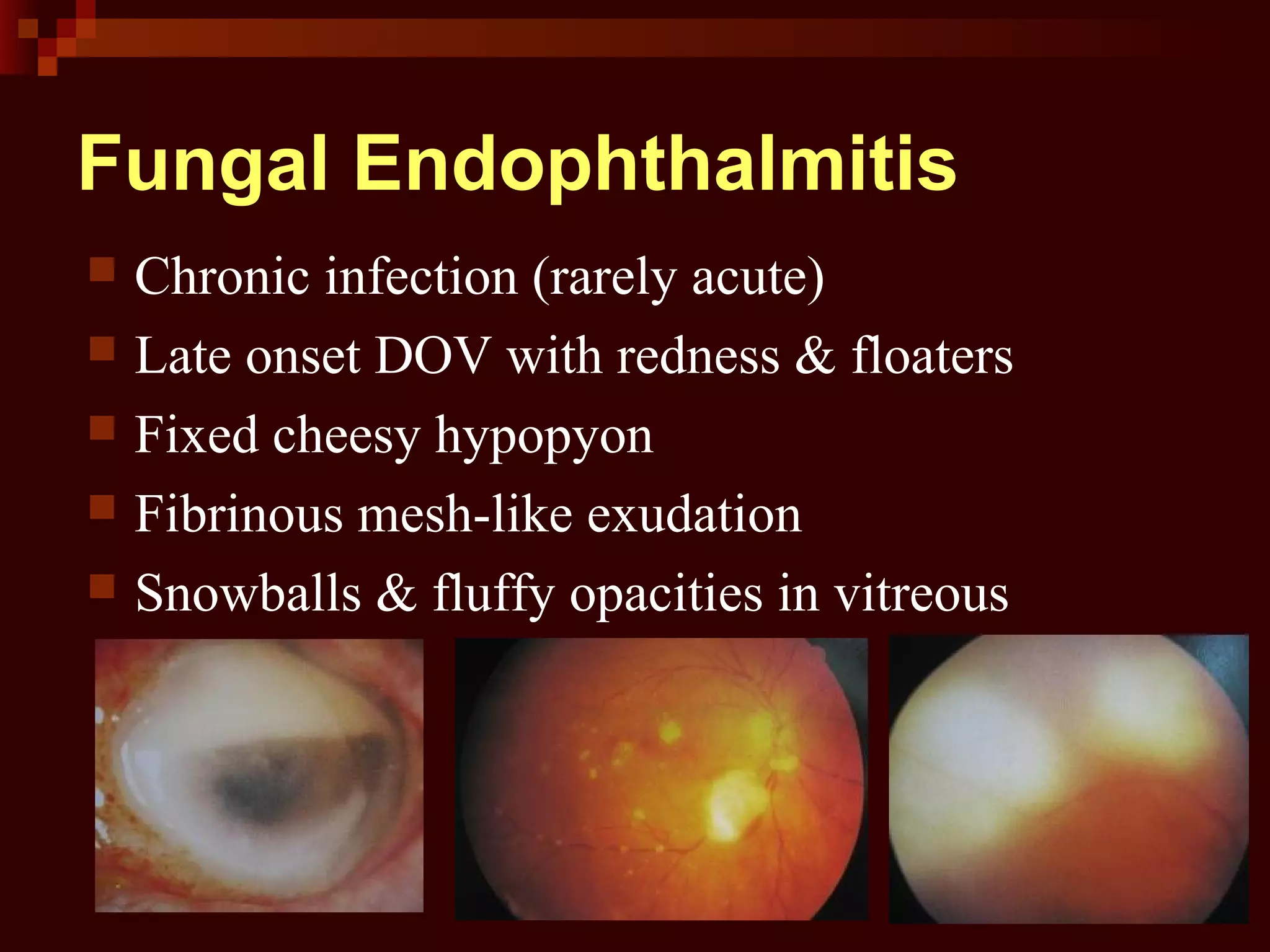 Endophthalmitis | PPT