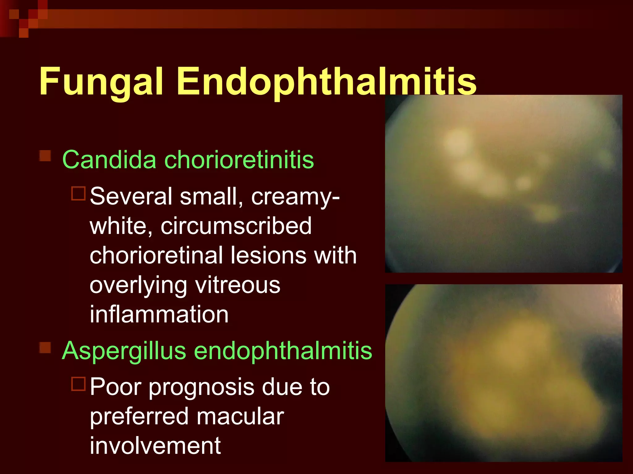 Endophthalmitis | PPT