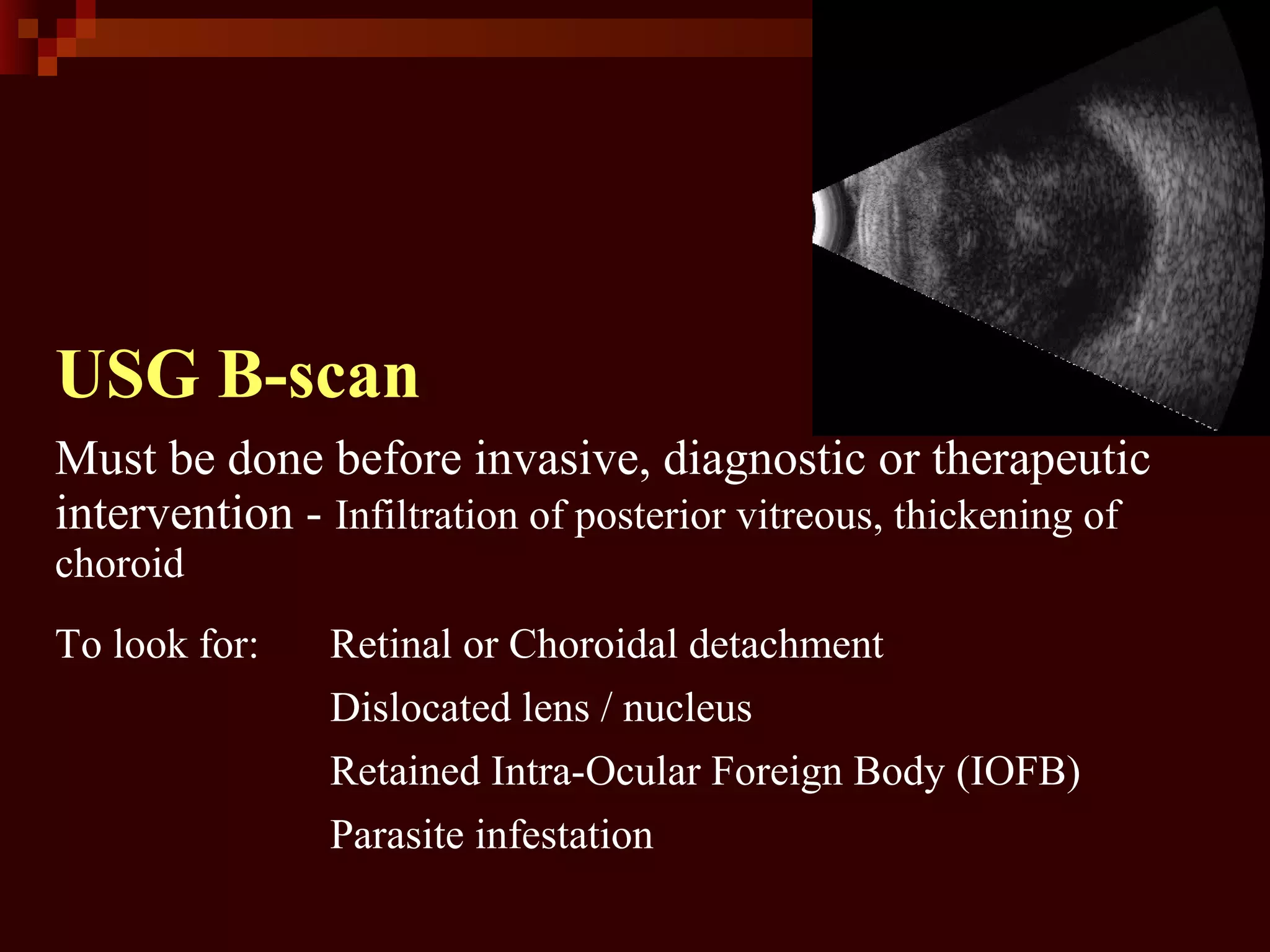 Endophthalmitis | PPT