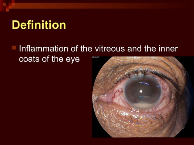 Endophthalmitis | PPT