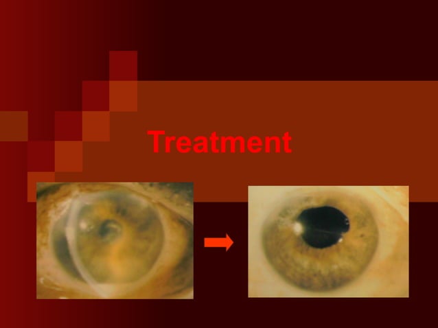 Endophthalmitis | PPT