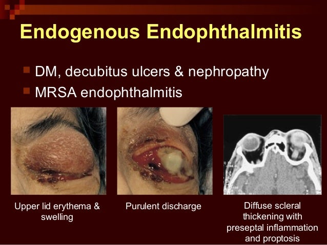 Endophthalmitis