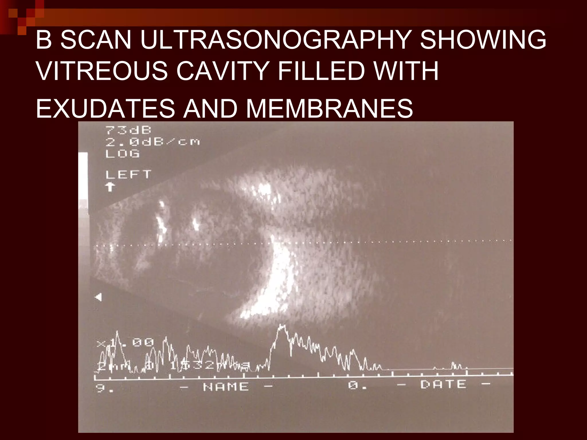 Endophthalmitis | PPT