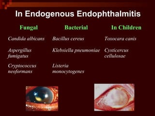 Endophthalmitis | PPT
