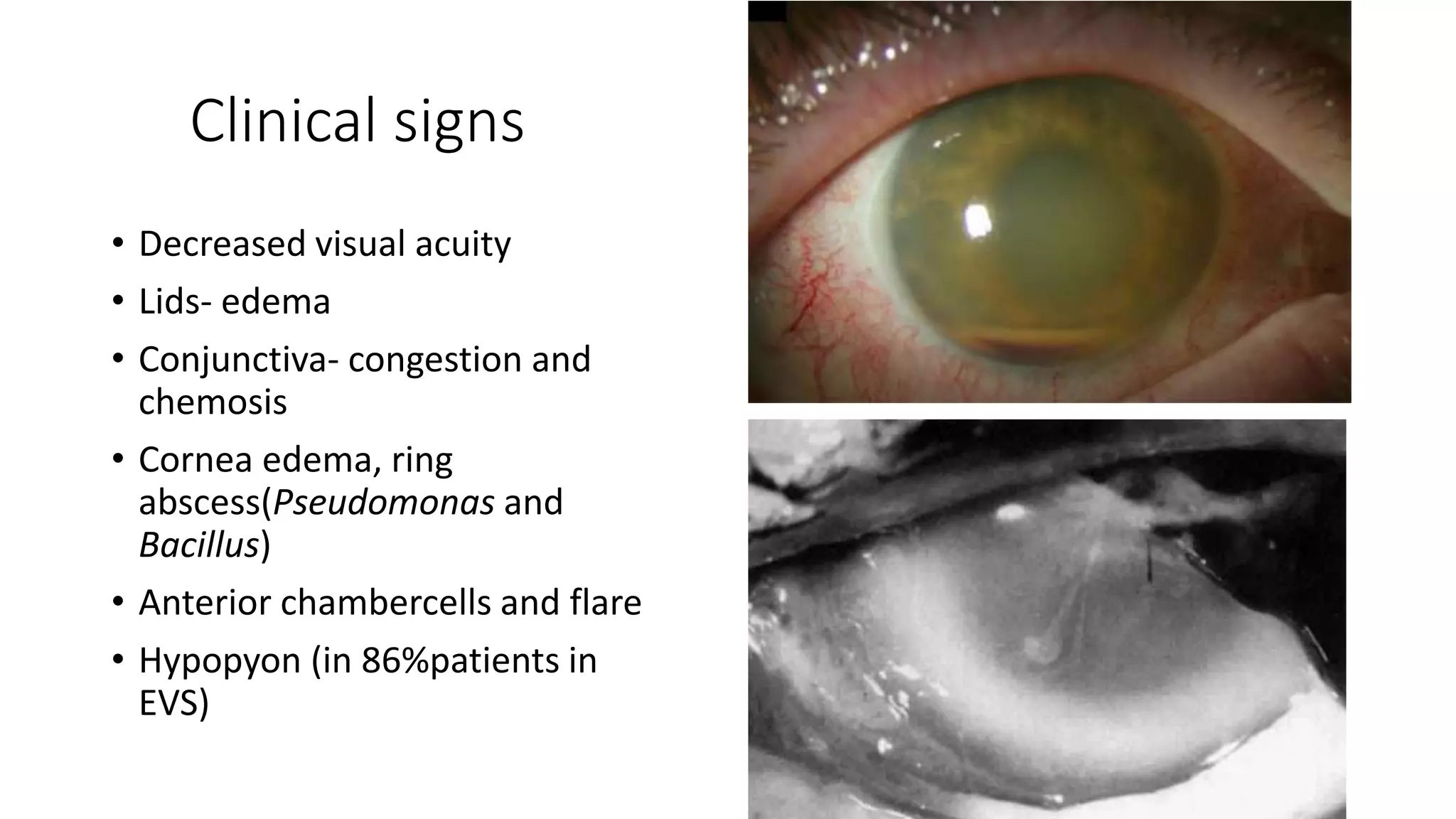 Endophthalmitis | PPTX