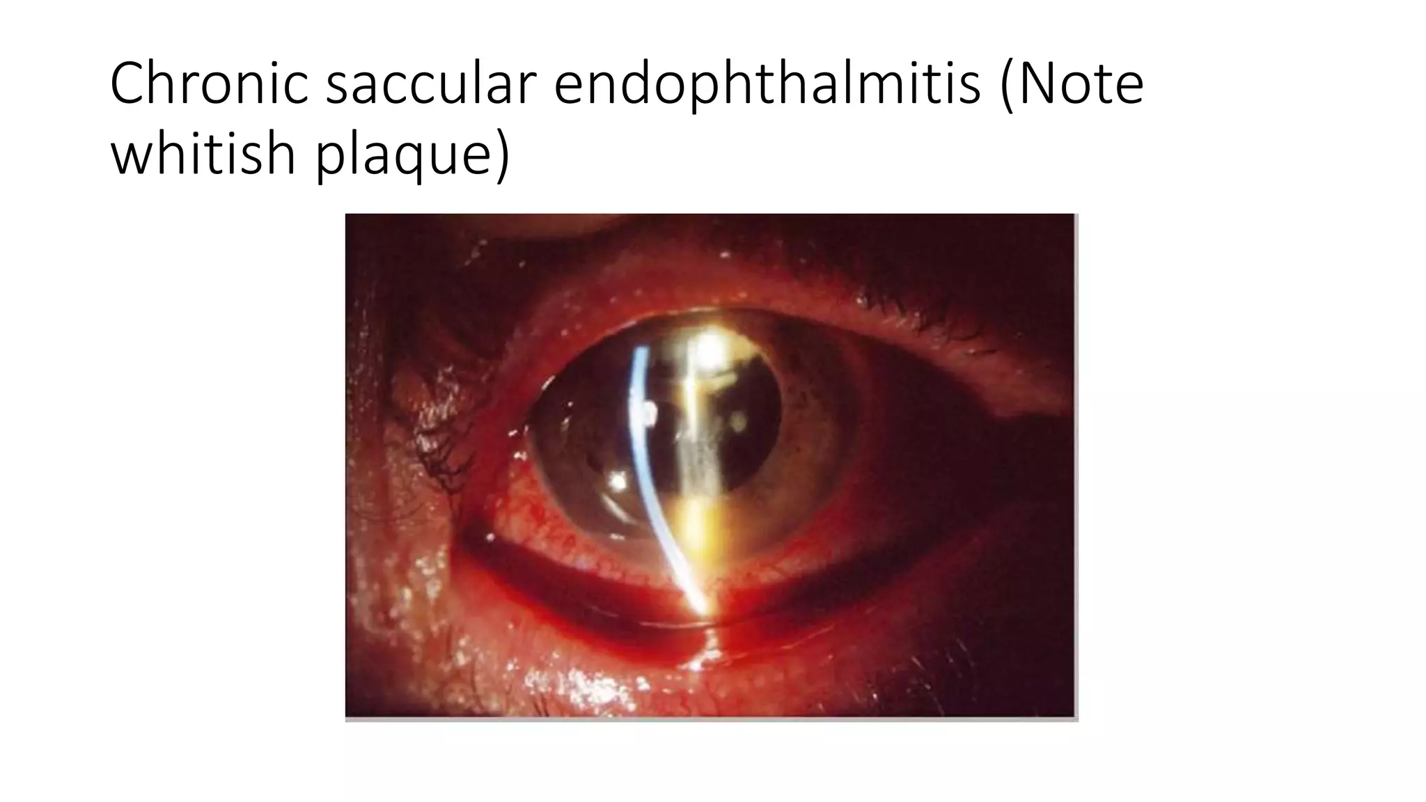 Endophthalmitis | PPTX