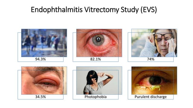 Endophthalmitis | PPTX