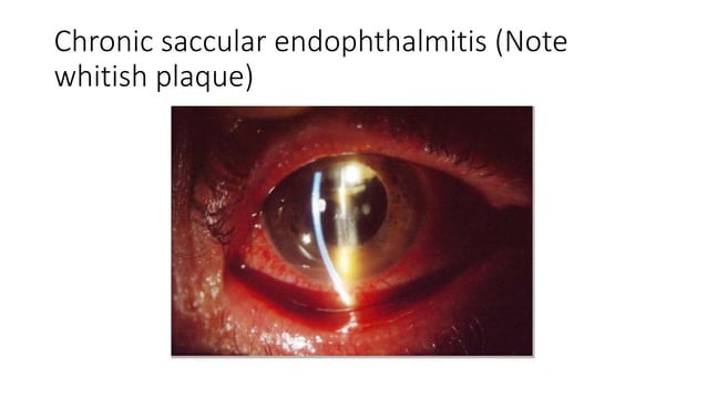 Endophthalmitis | PPTX
