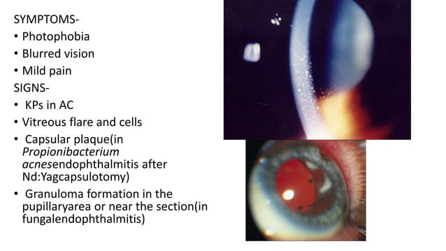 Endophthalmitis | PPTX