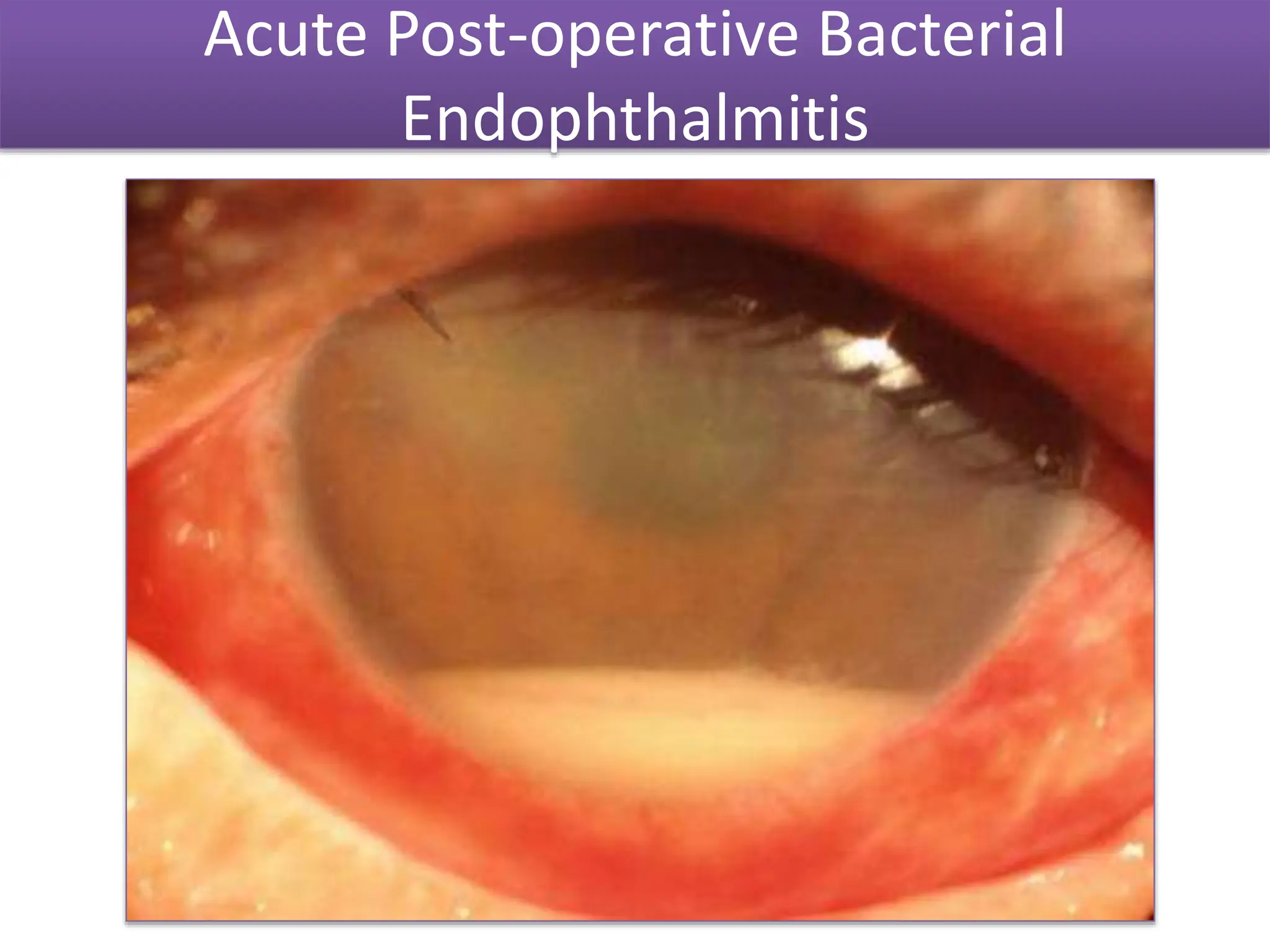 ENDOPHTHALMITIS.PRABIN.pptx