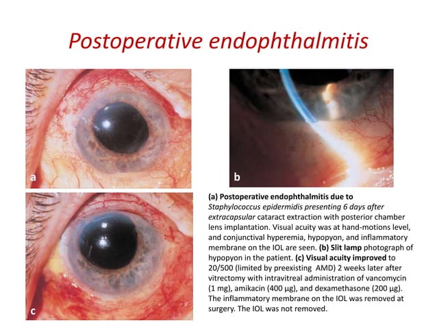 Endophthalmitis.pptx