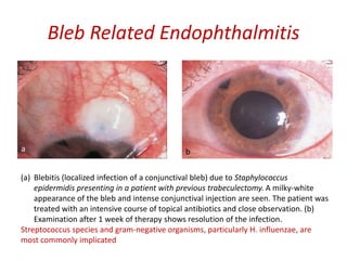 Endophthalmitis.pptx