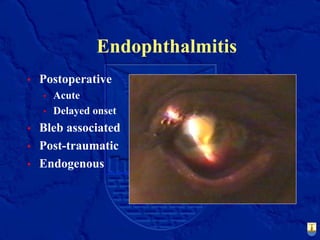 Endophthalmitis | PPT