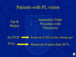 Five year experience in the treatment of Endophthalmitis | PPT