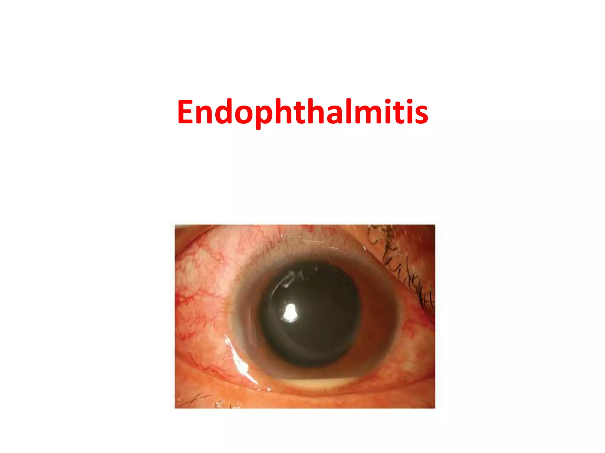 Endophthalmitis vinit | PPTX