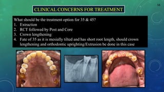 endo prostho useful information on endo prostho | PPTX