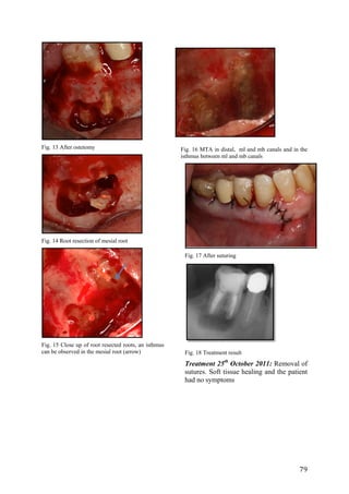 Endo protocols | PDF