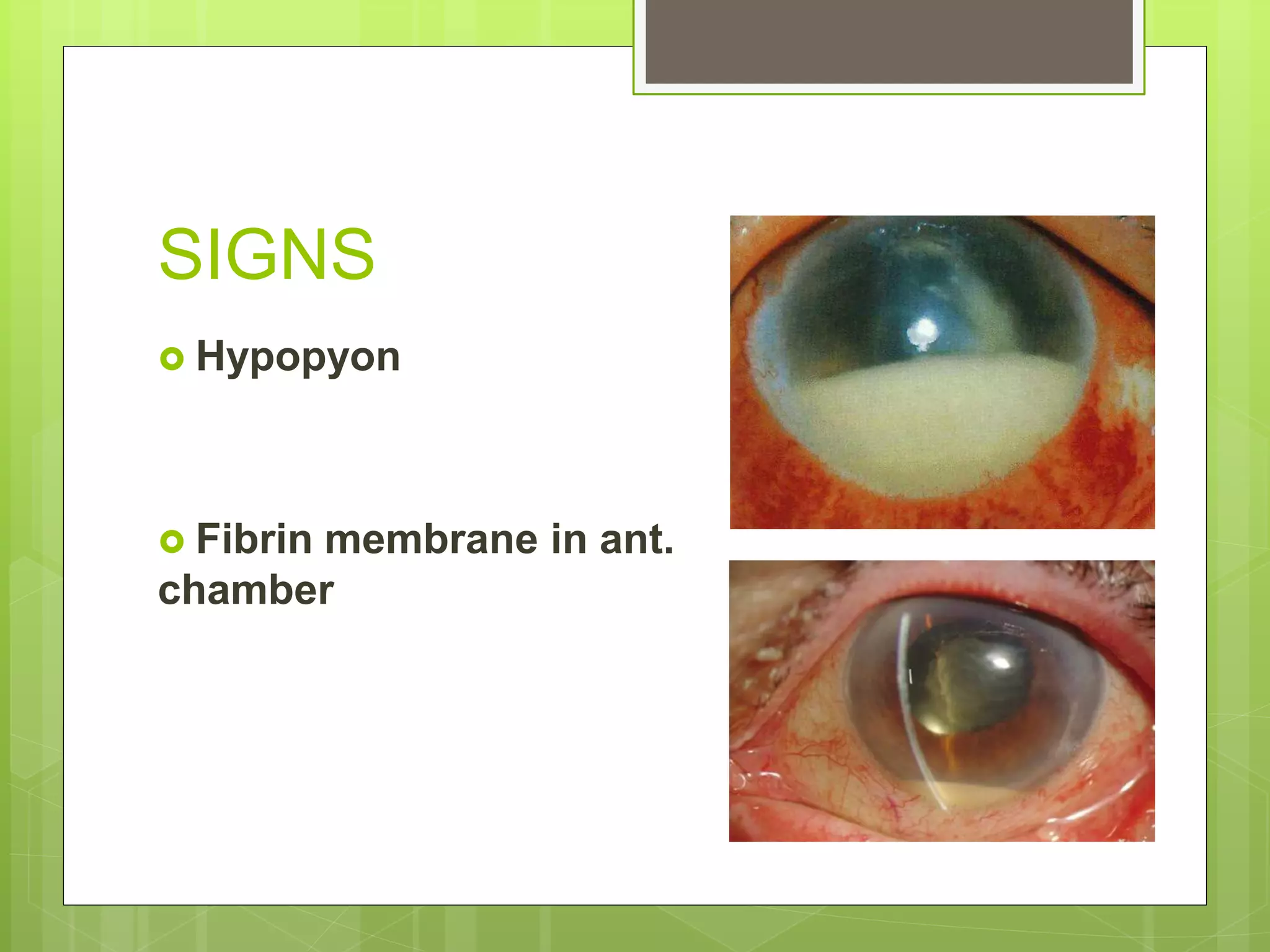 Endopthalmitis | PPT