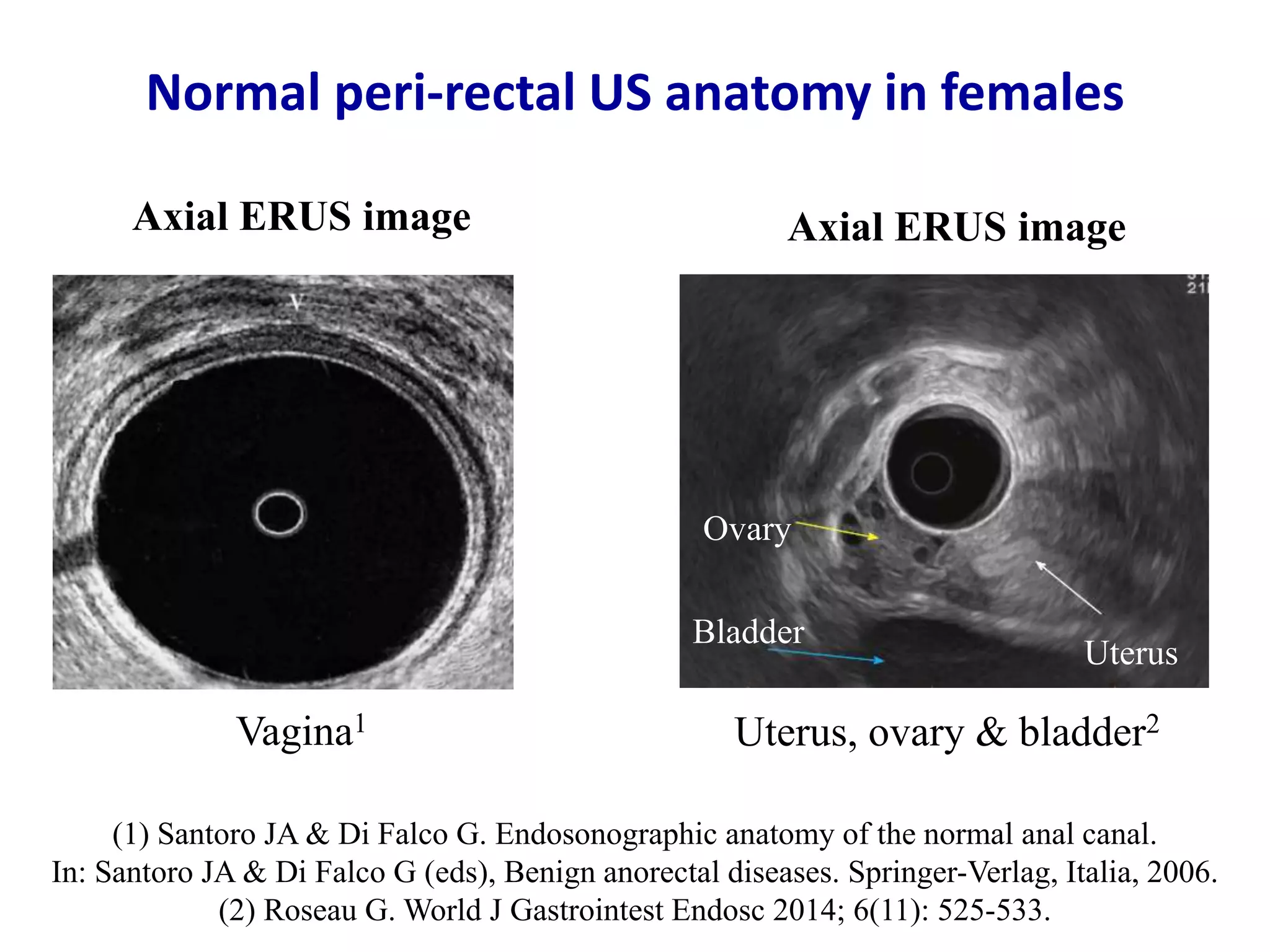 Endorectal ultrasound in rectal diseases | PPTX