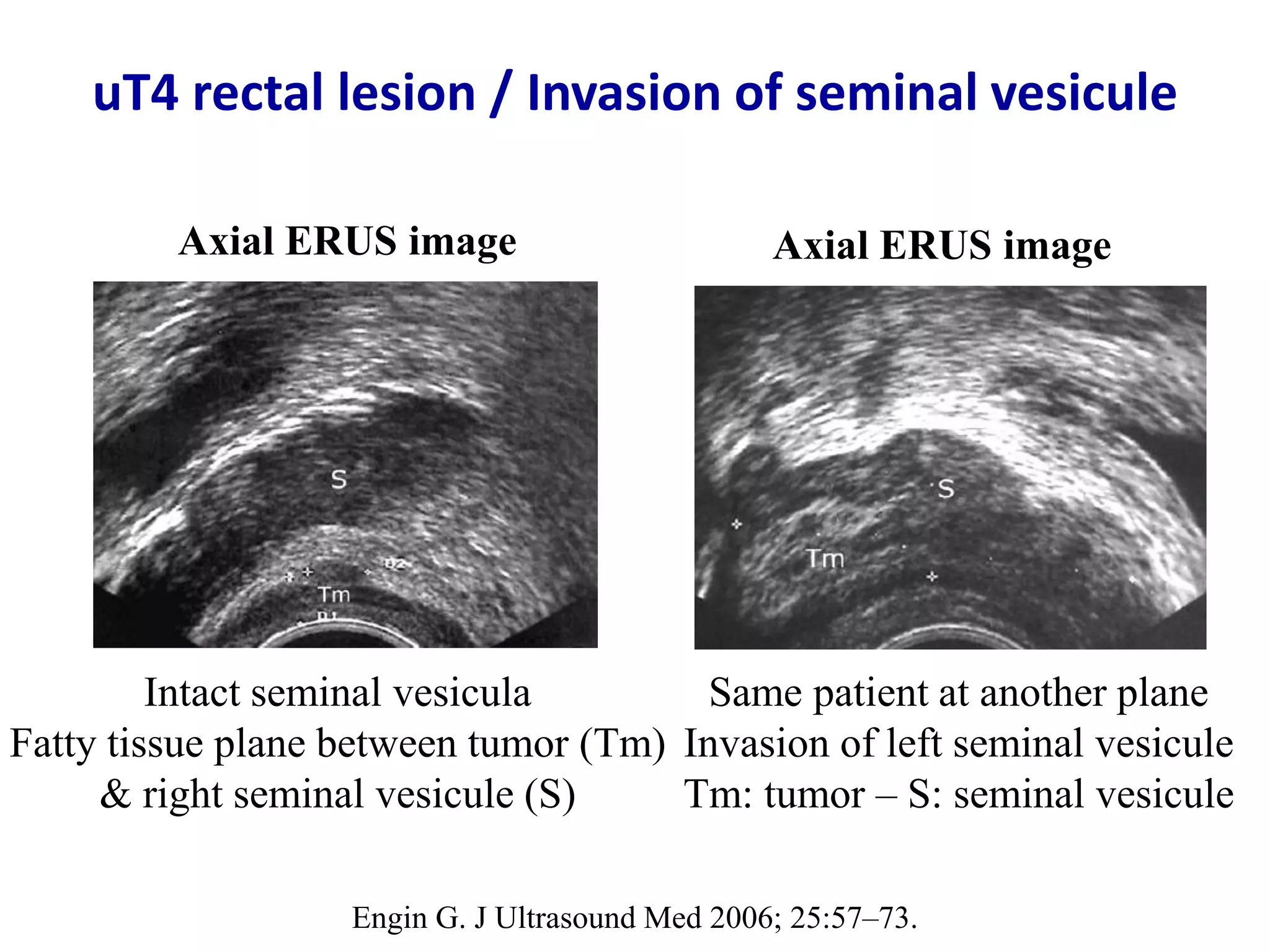 Endorectal ultrasound in rectal diseases | PPTX