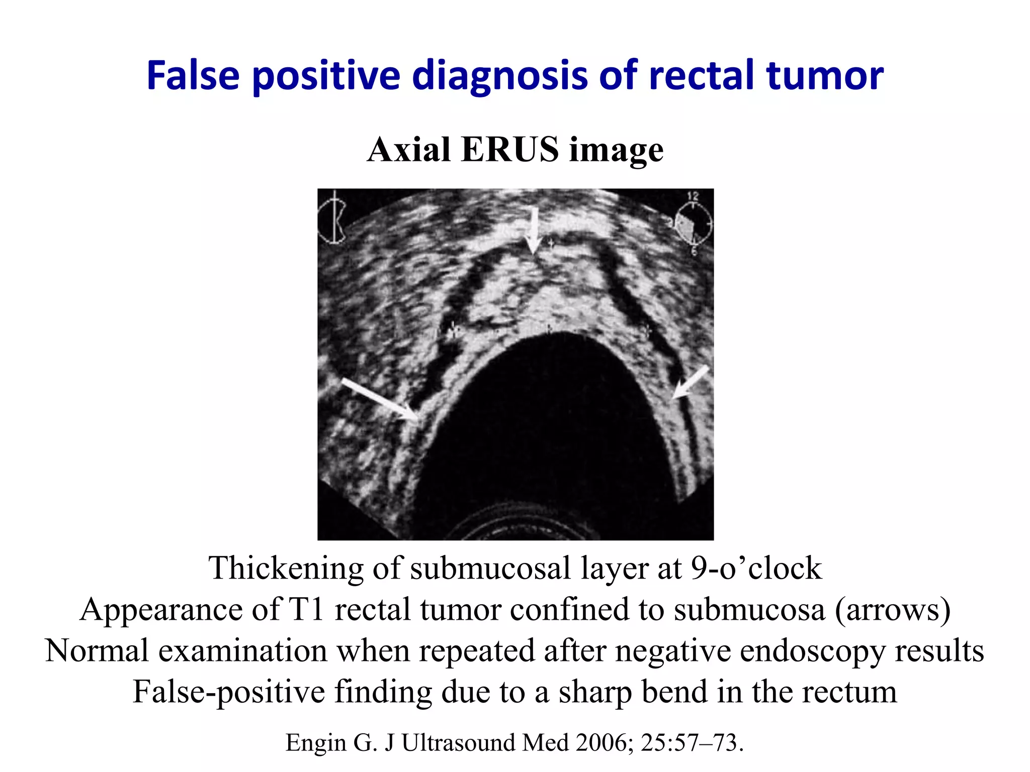 Endorectal ultrasound in rectal diseases | PPTX