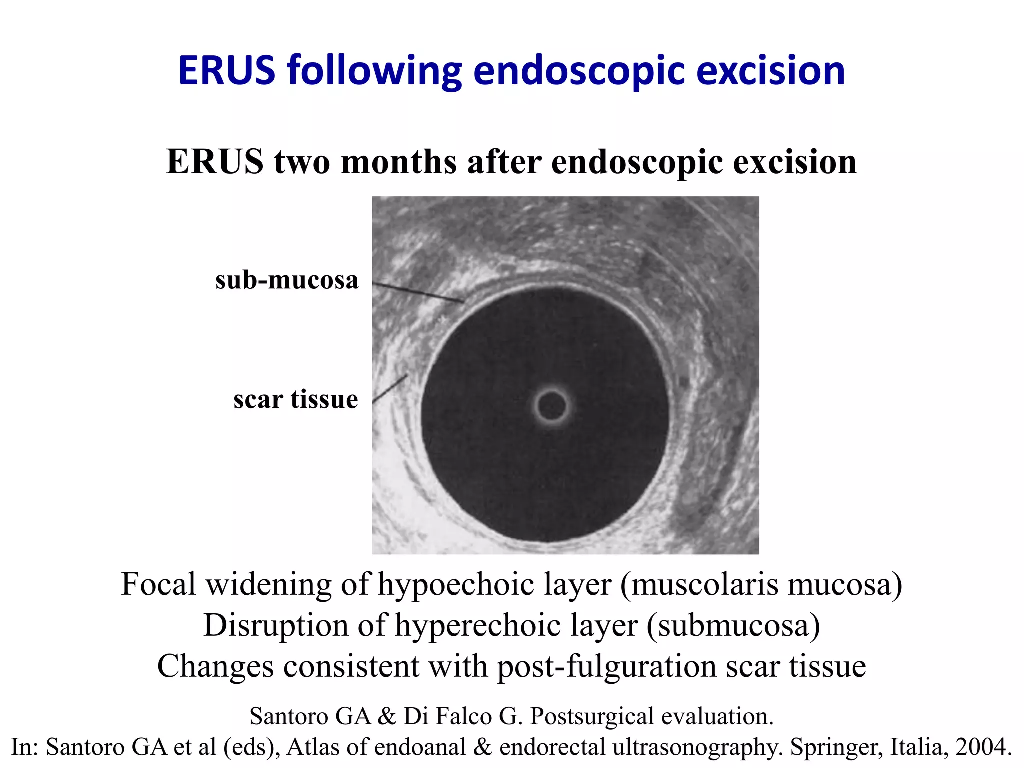 Endorectal ultrasound in rectal diseases | PPTX