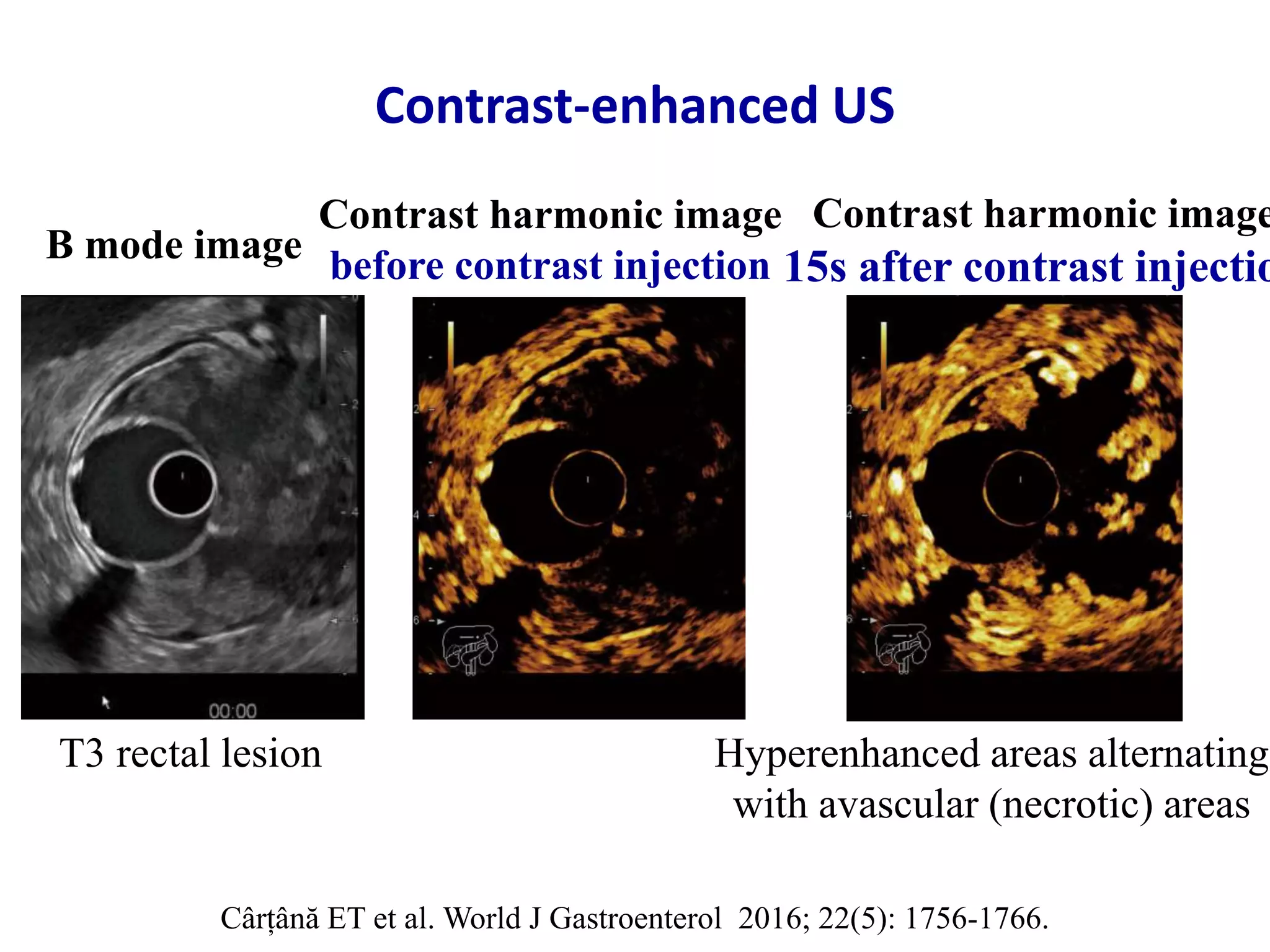 Endorectal ultrasound in rectal diseases | PPTX