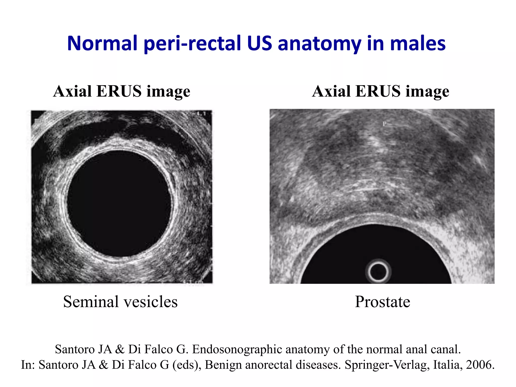 Endorectal ultrasound in rectal diseases | PPTX