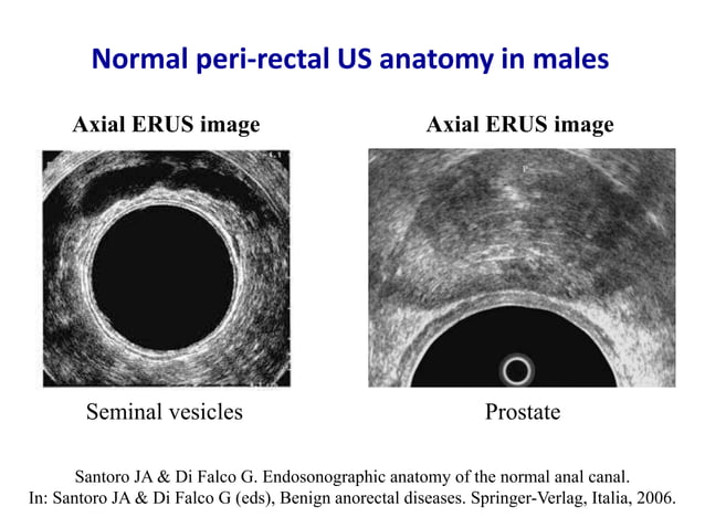Endorectal Ultrasound In Rectal Diseases
