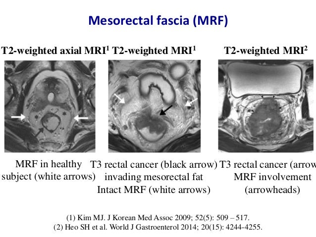 Endorectal ultrasound in rectal diseases