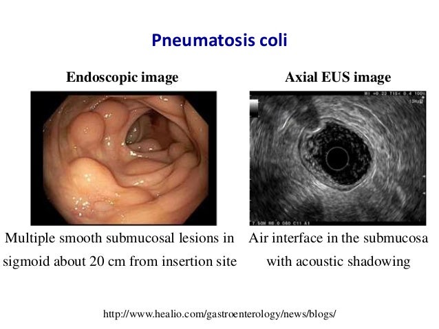 Endorectal ultrasound in rectal diseases