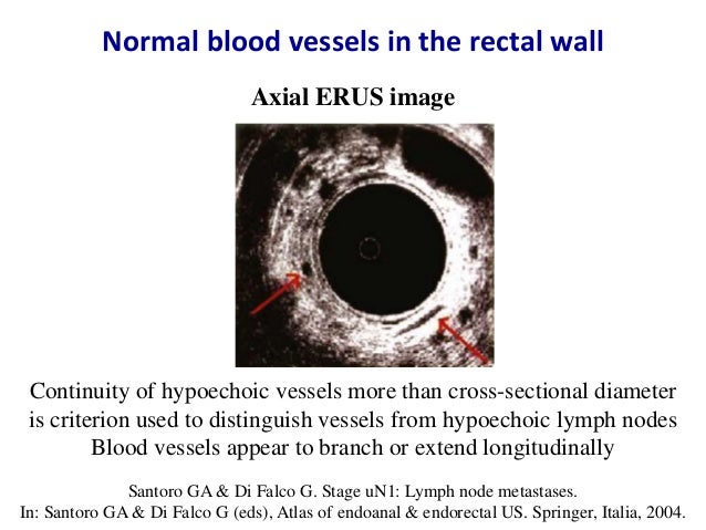 Endorectal Ultrasound In Rectal Diseases