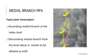 Endoscopic RF in Chronic LBP | PPT