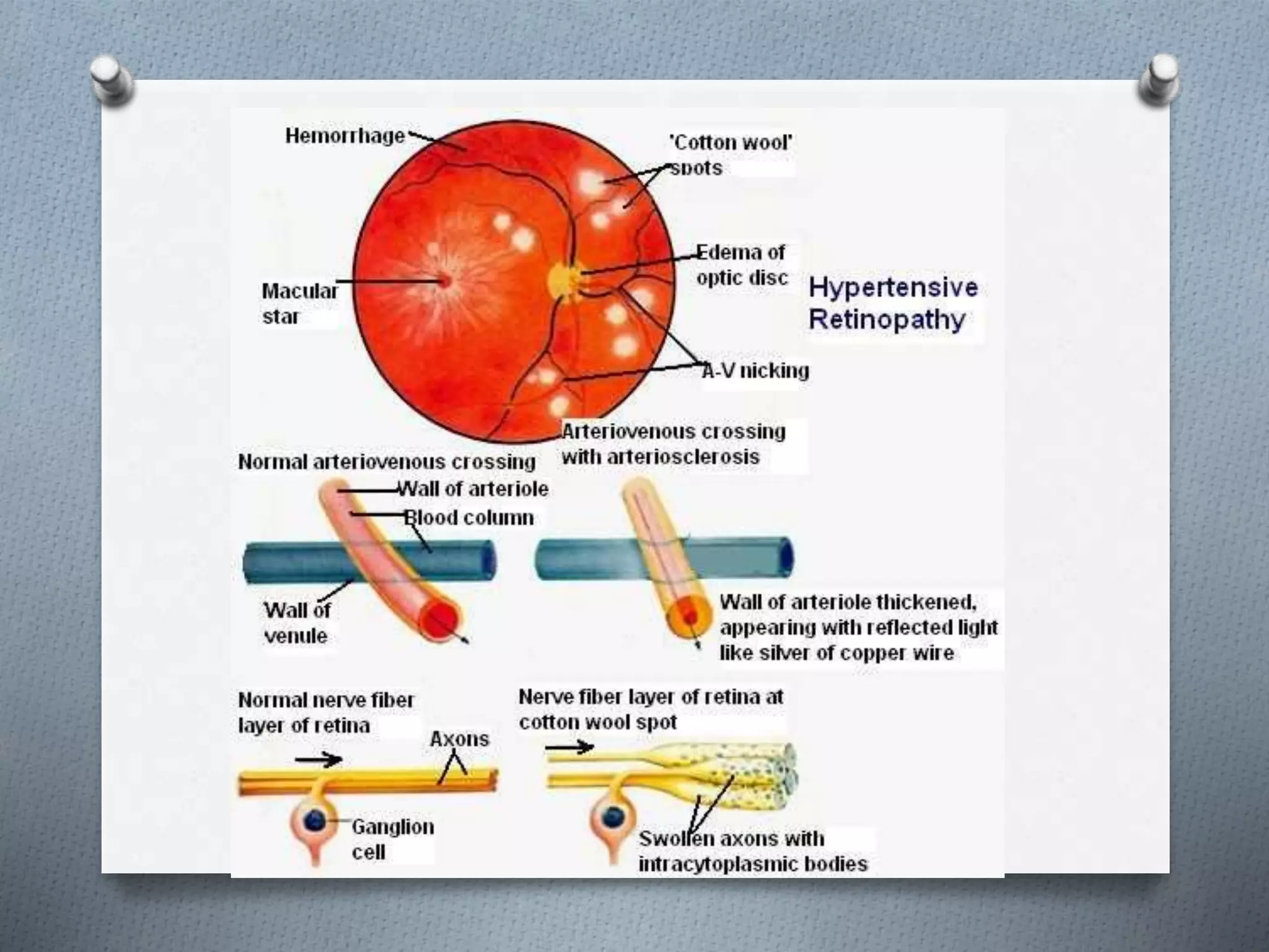 End Organ Damage In HypertensionDARB.pptx