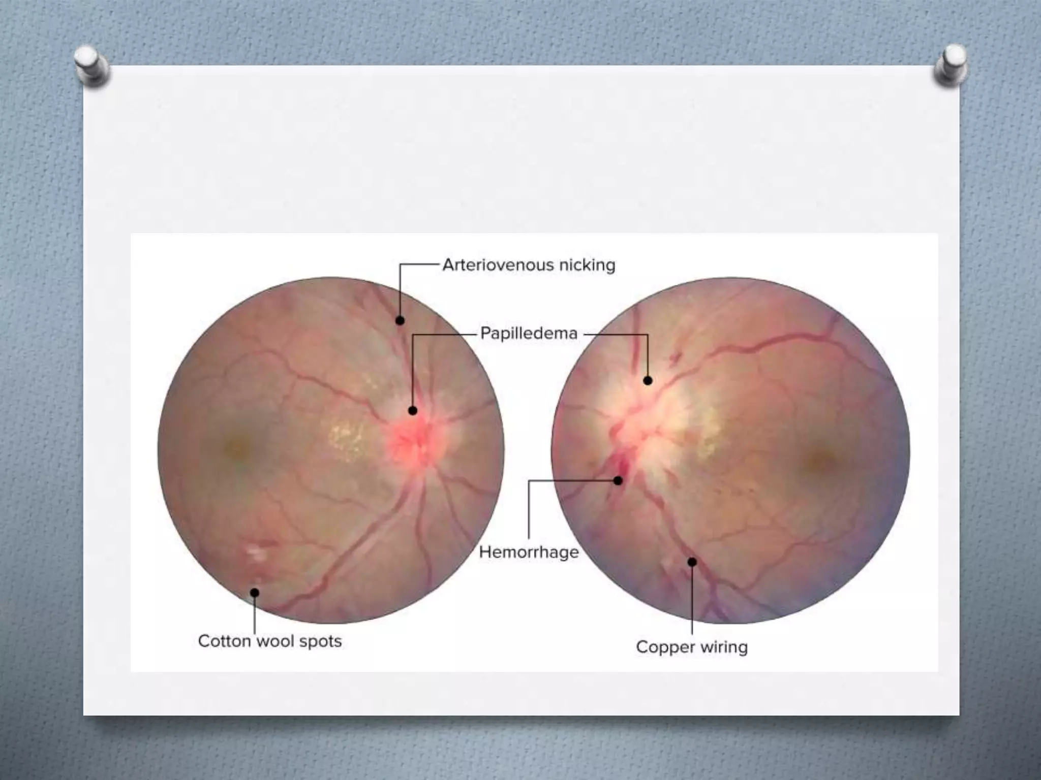 End Organ Damage In HypertensionDARB.pptx