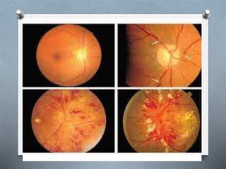 End Organ Damage In HypertensionDARB.pptx