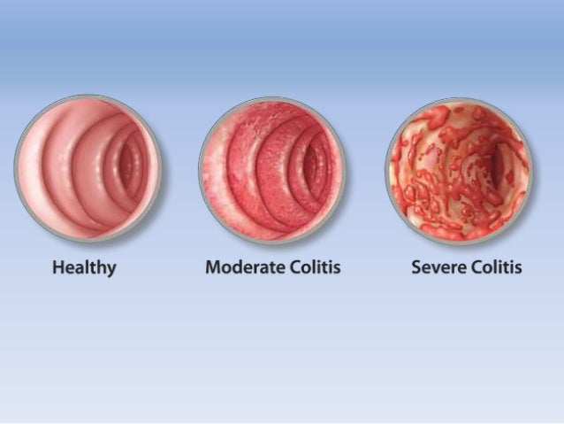 ENDOSCOPY ROLE IN INFLAMMATORY BOWEL DISEASE, ENDOSCOPY HISORY