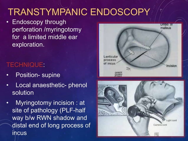 Endoscope assisted middle ear surgery | PPT
